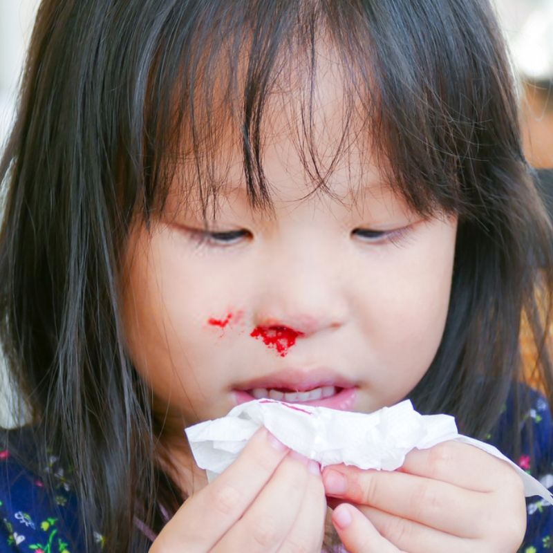 Hidung Berdarah? Ini Cara Hentikan Pendarahan - November 2024 ...