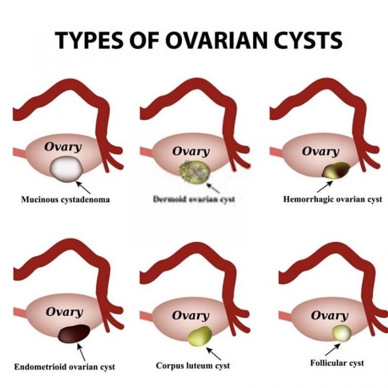 Ovarian Cyst Takkan Sembuh Dengan Suplemen, Jangan Tertipu! - November ...