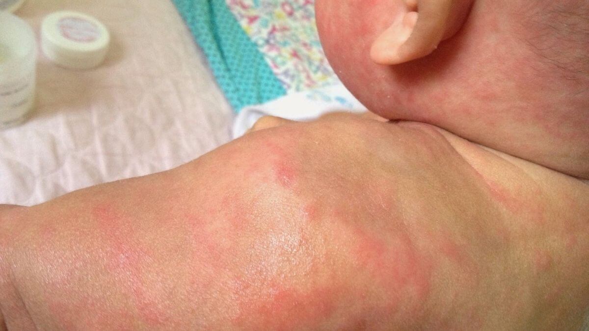 Ruam Panas Bayi? Ini Cara Merawatnya (Ketahui Punca & Rawatan)