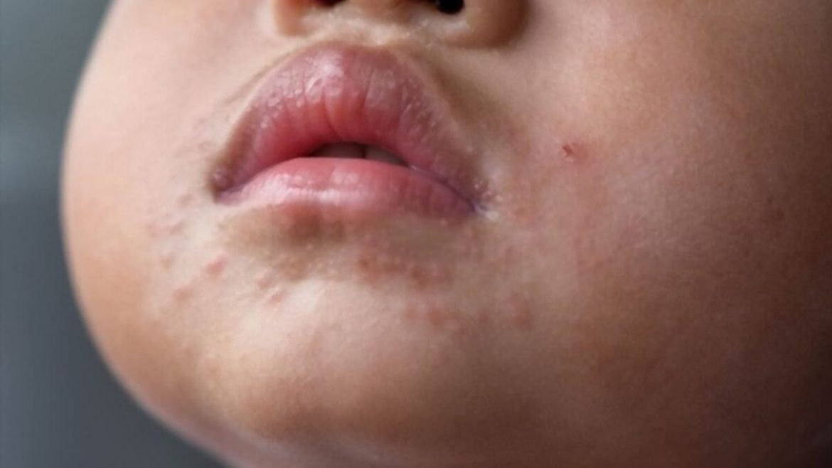 6 Jenis Ruam Bayi Yang Ibu Bapa Harus Tahu & Cara Mengatasinya