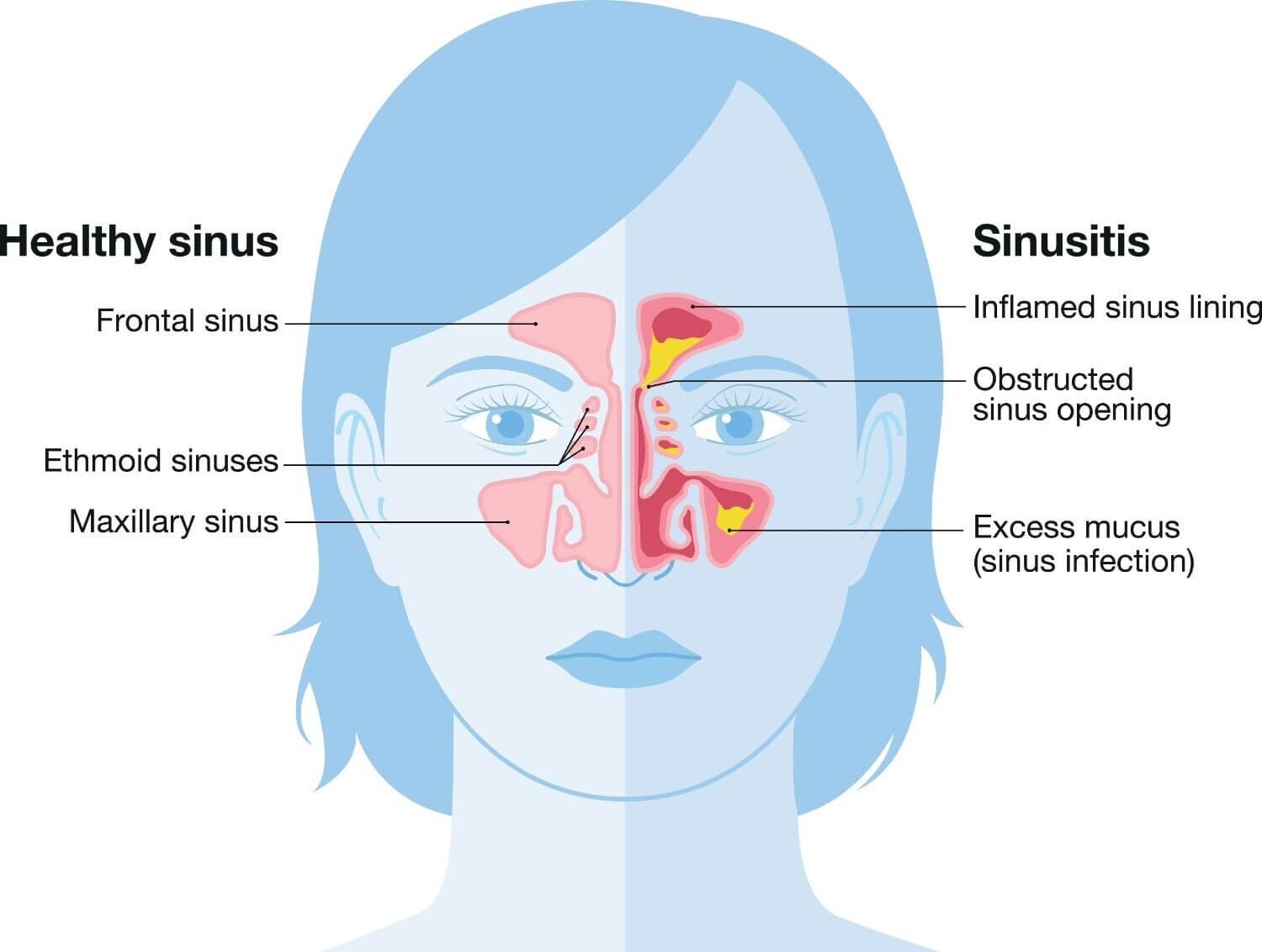 "Rasa macam ada ulat dalam hidung!" Pakar Bongkarkan Fakta Resdung