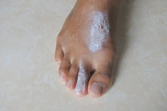 Kudis Buta 101! Kenali Punca, Simptom, Rawatan Pada Anak-Anak (2025)