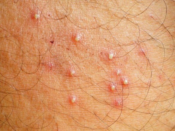 Boleh Buta! Ini Antara 7 Kesan Lain Penggunaan Ubat Steroid Yang ...