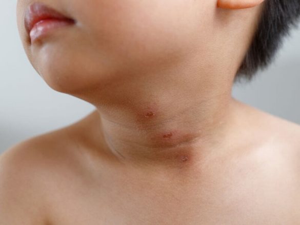 Sakit Kalau Kena! Cuba 15 Cara Hilangkan Semut Charlie Ini - 2025