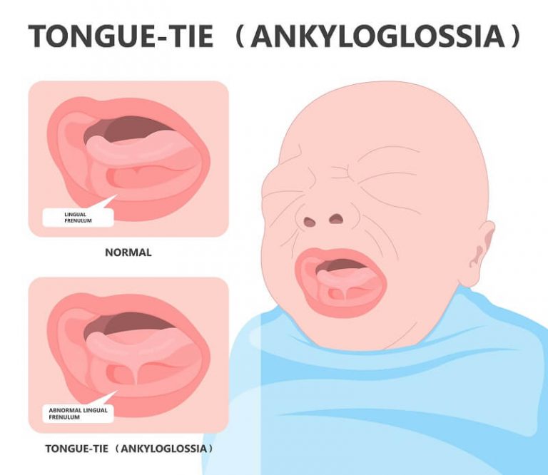 Periksa Lidah Anak Mama: Tongue-Tie atau Lidah Normal? - 2026