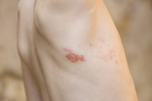 Mengapa Kita Boleh Menjangkiti Kayap Ular? Memahami "Herpes Zoster"