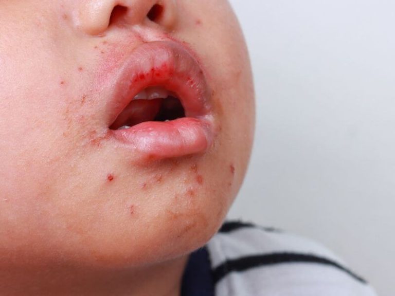 Punca Lelangit Bengkak dan Tips Melegakannya Secara Semula Jadi