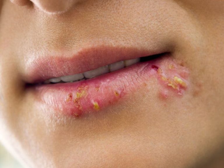 Punca Lelangit Bengkak dan Tips Melegakannya Secara Semula Jadi