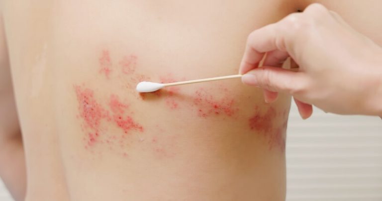 Mengapa Kita Boleh Menjangkiti Kayap Ular? Memahami "Herpes Zoster"