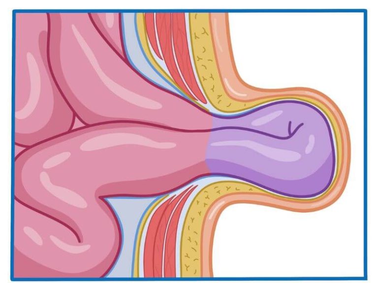 Angin Pasang Bukan Sekadar Kembung! Ini Penjelasan Pakar