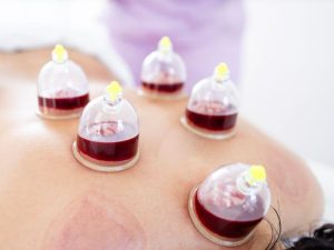 Bekam – Betul-Betul Berkesan atau Sekadar Trend? - 2025 | KelabMama