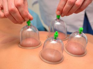 Bekam – Betul-Betul Berkesan atau Sekadar Trend? - 2025 | KelabMama